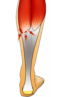 Kuitbeen bandage en kuitbrace